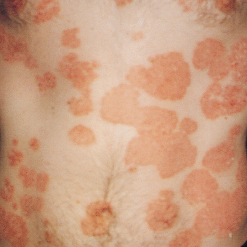 Psoriasis Support – Plunkett Pharmaceuticals
